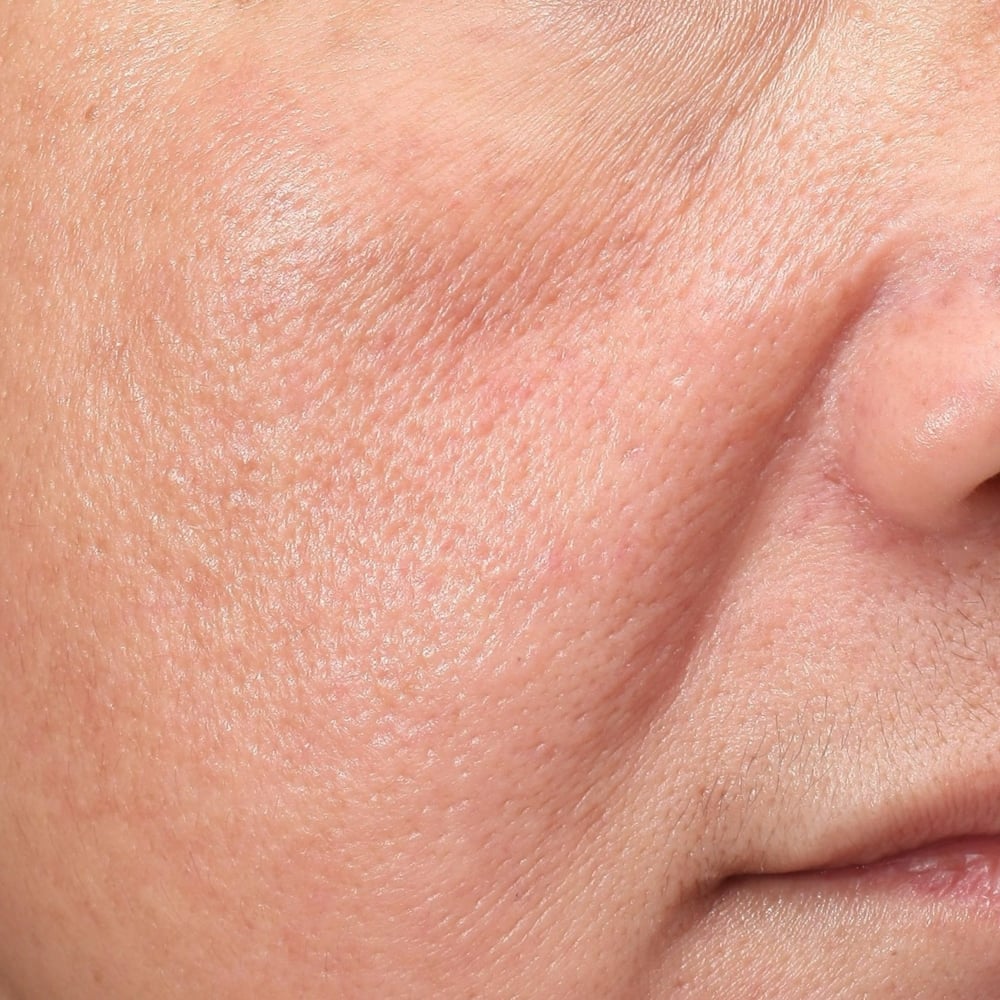 Dry & Dull Skin | Discover Treatments at Evergreen MD Aesthetics