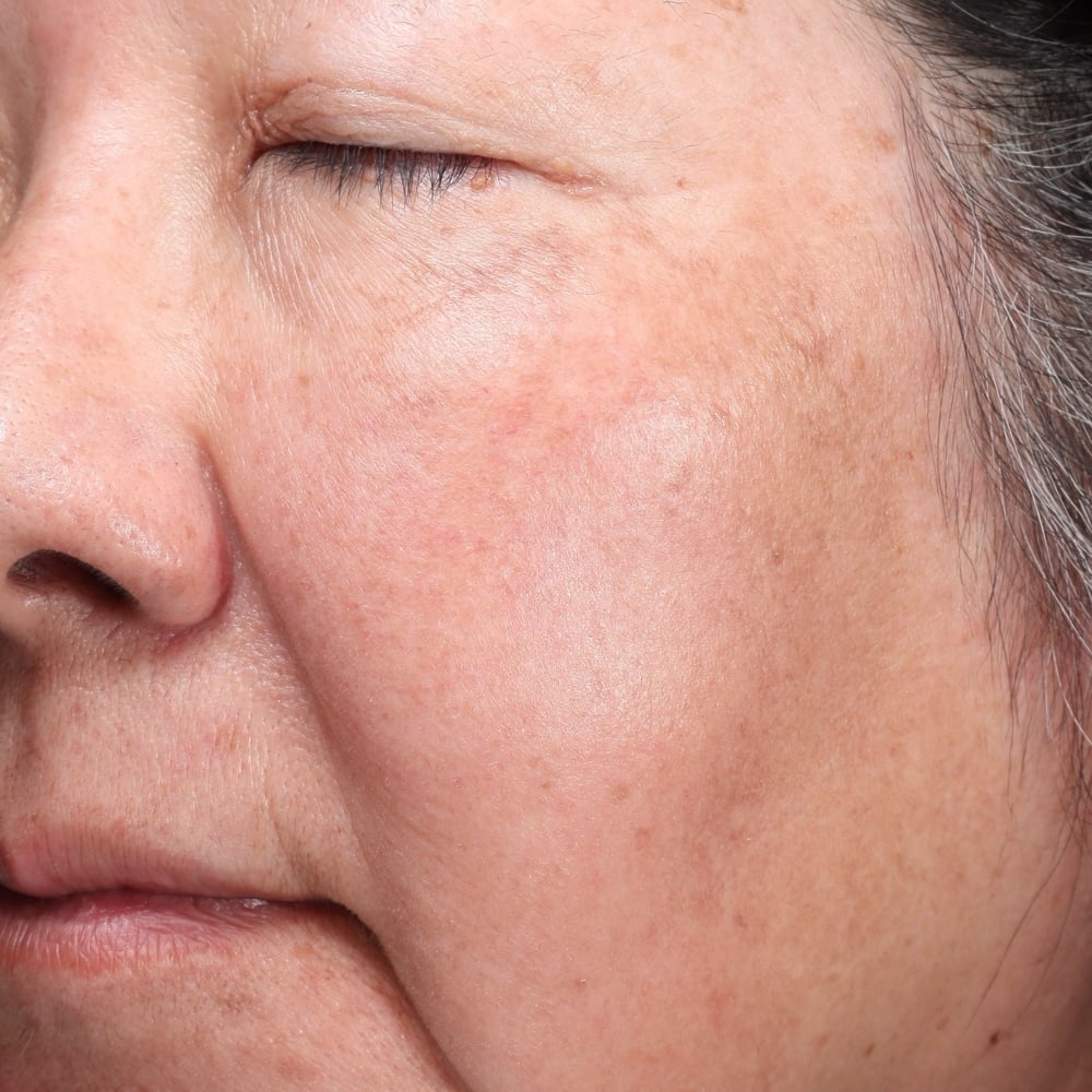 Skin Discolouration, Redness & Brown Spots | Treatments at Evergreen MD ...