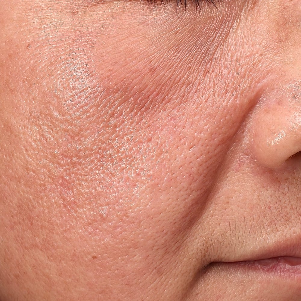 Skin Discolouration, Redness & Brown Spots | Treatments at Evergreen MD ...