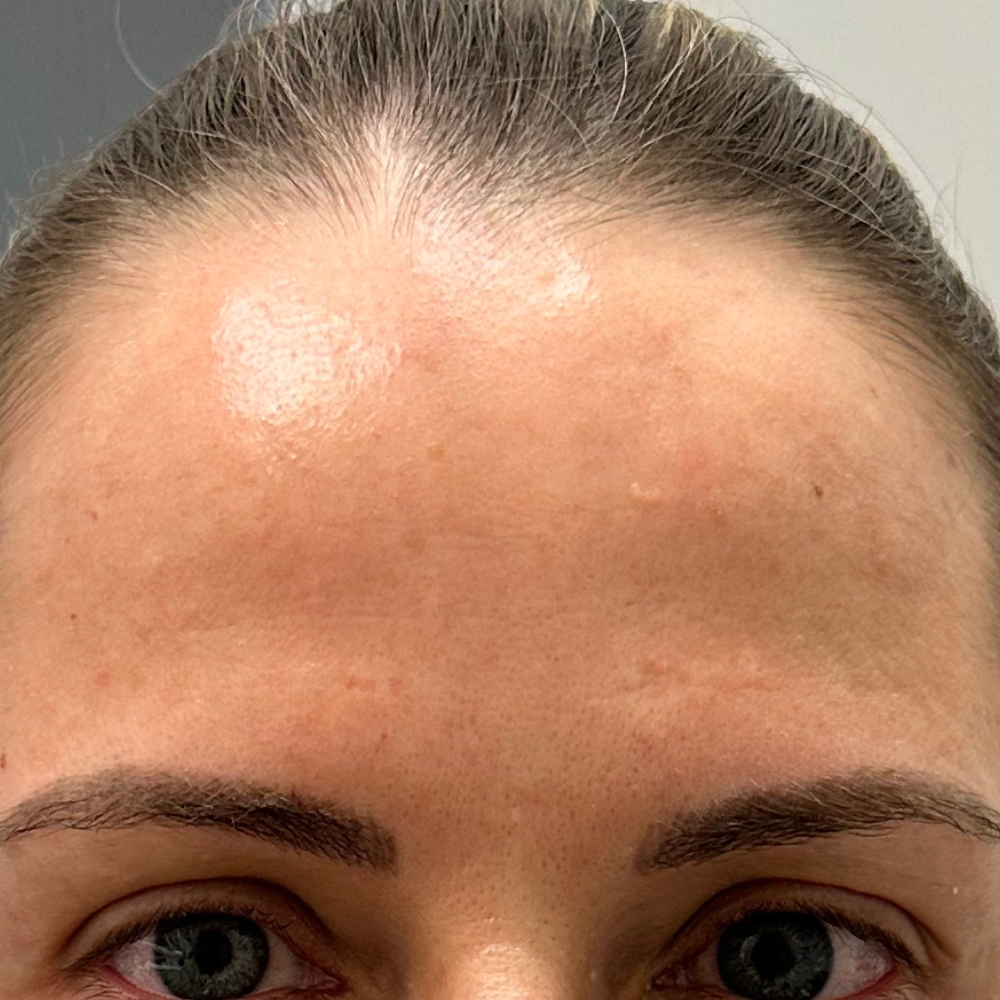 Wrinkle Relaxers & Neuromodulators at Evergreen MD Aesthetics
