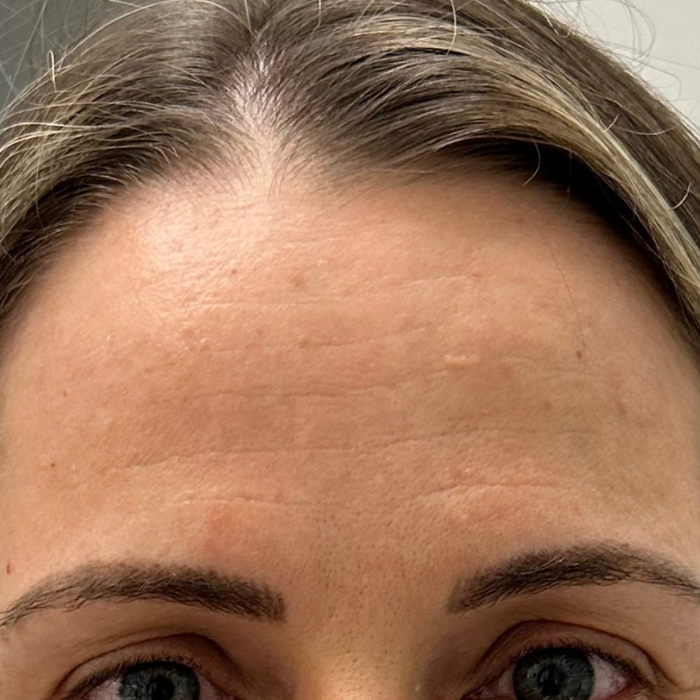 Wrinkle Relaxers & Neuromodulators at Evergreen MD Aesthetics